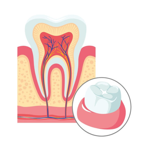 The 5 Stages of Tooth Decay & How to Stop It Early | Cedar Walk Dentistry