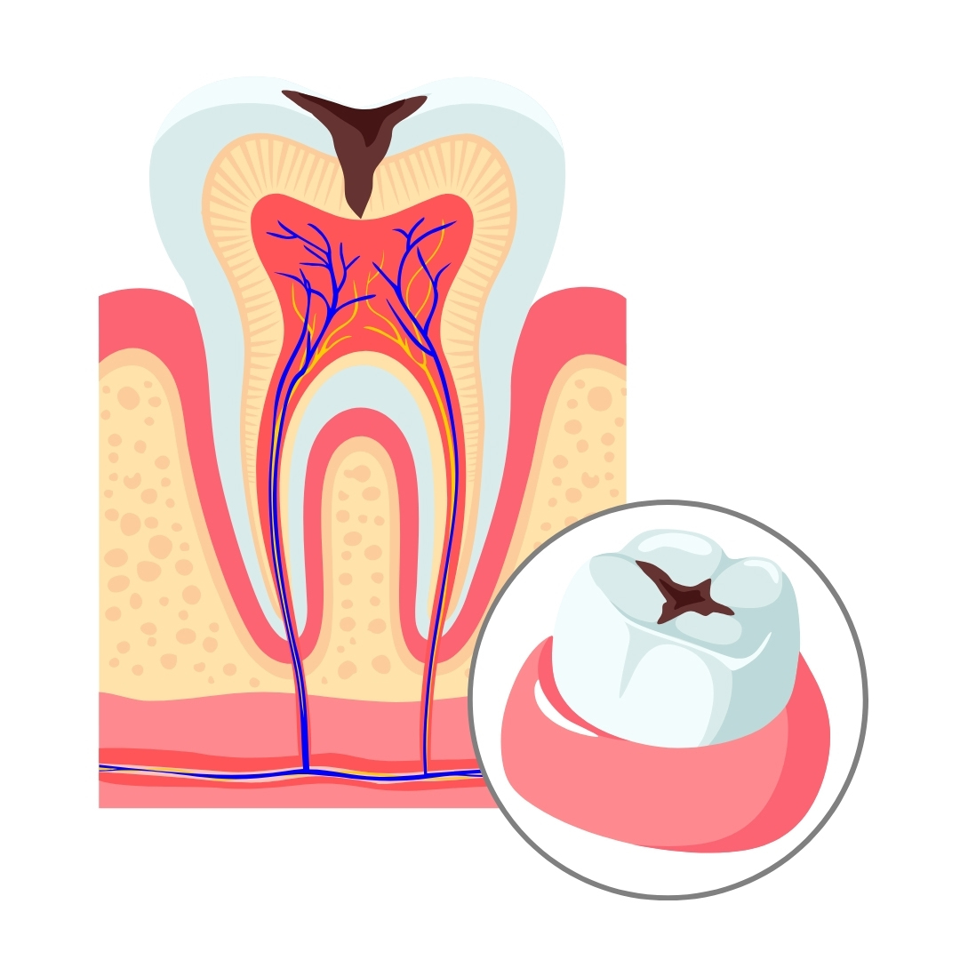 The 5 Stages of Tooth Decay & How to Stop It Early | Cedar Walk Dentistry