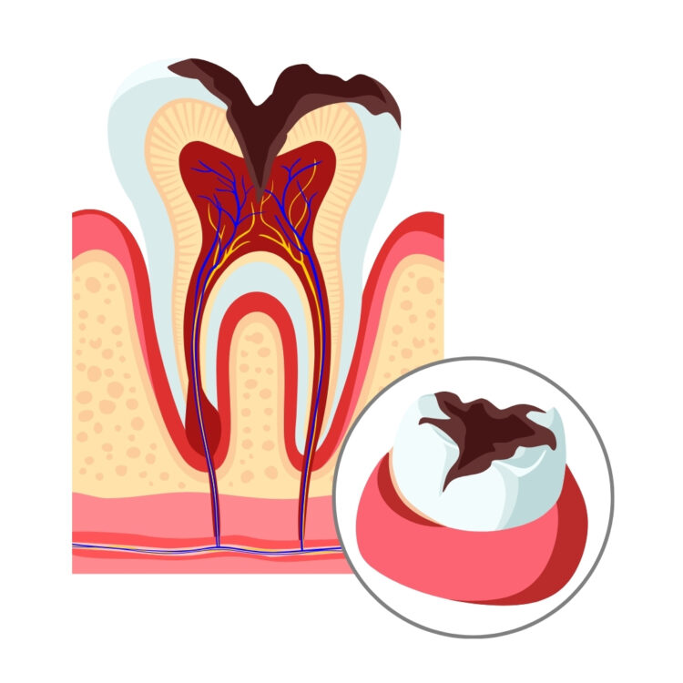 The 5 Stages of Tooth Decay & How to Stop It Early | Cedar Walk Dentistry