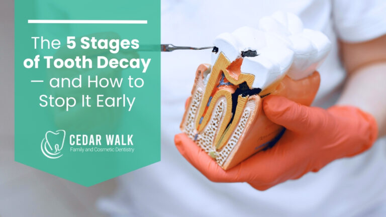 The 5 Stages of Tooth Decay & How to Stop It Early | Cedar Walk Dentistry
