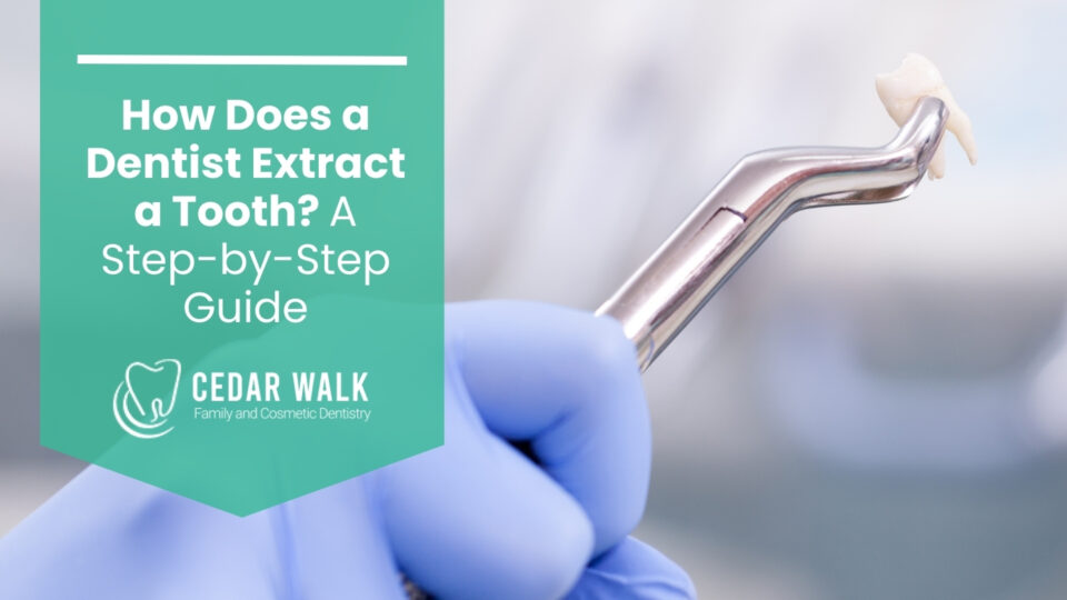 How Does a Dentist Extract a Tooth? A Step-by-Step Guide | Cedar Walk ...